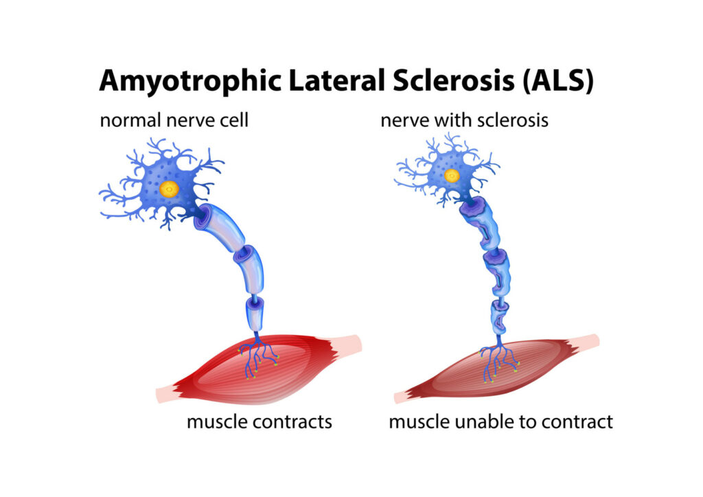 Esclerose Lateral Amiotrófica » Dr André Sobierajski dos Santos