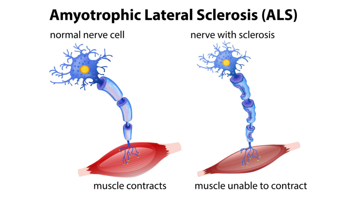 Esclerose Lateral Amiotrófica » Dr André Sobierajski dos Santos